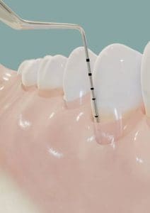 Why Does the Hygienist Poke Me With That Sharp Thing and Make Me Bleed?